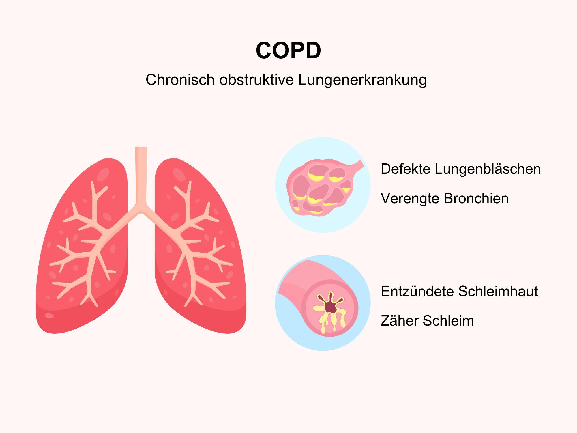 COPD | Schwabe Austria