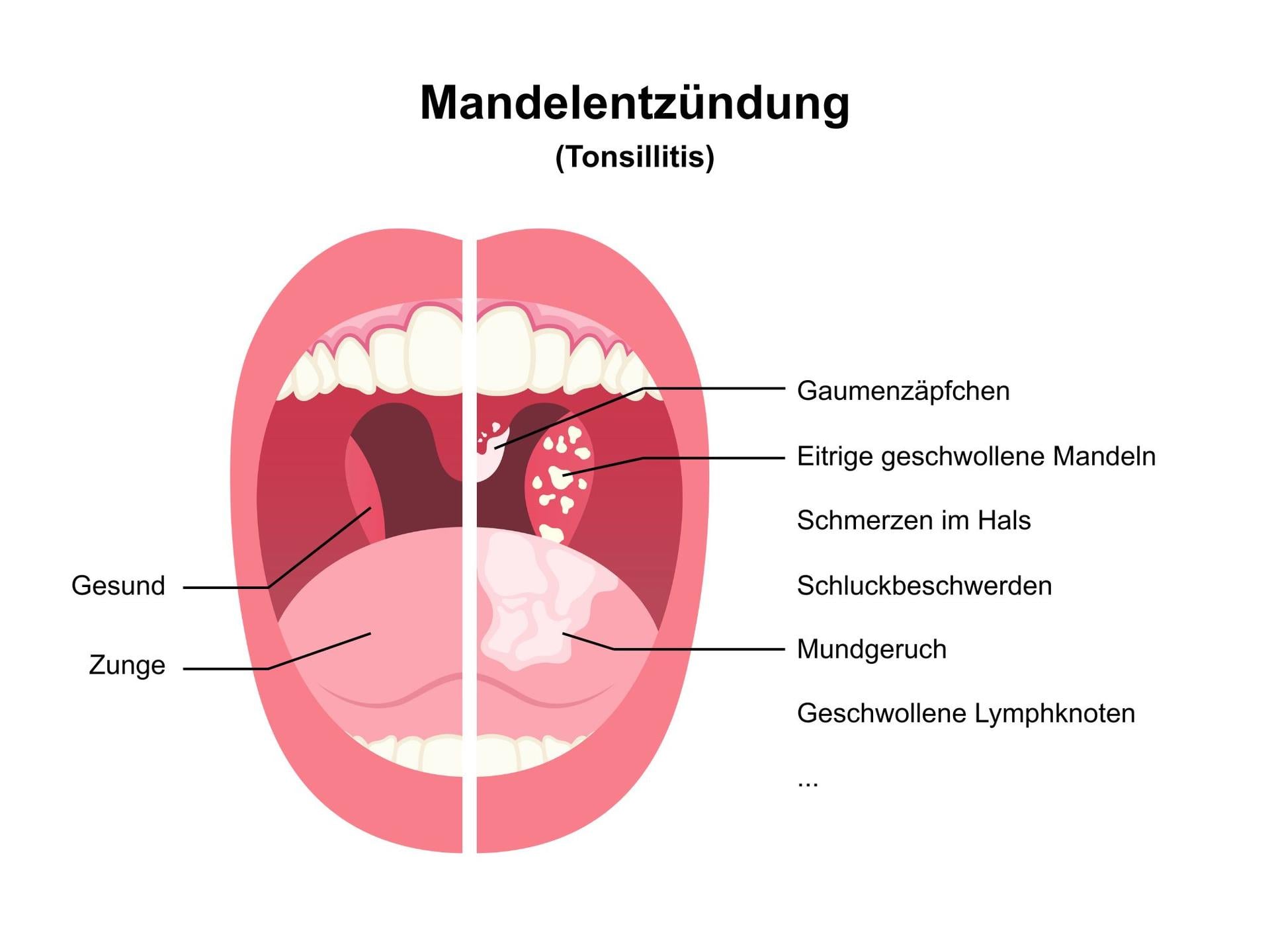 Mandelentzündung | Schwabe Austria