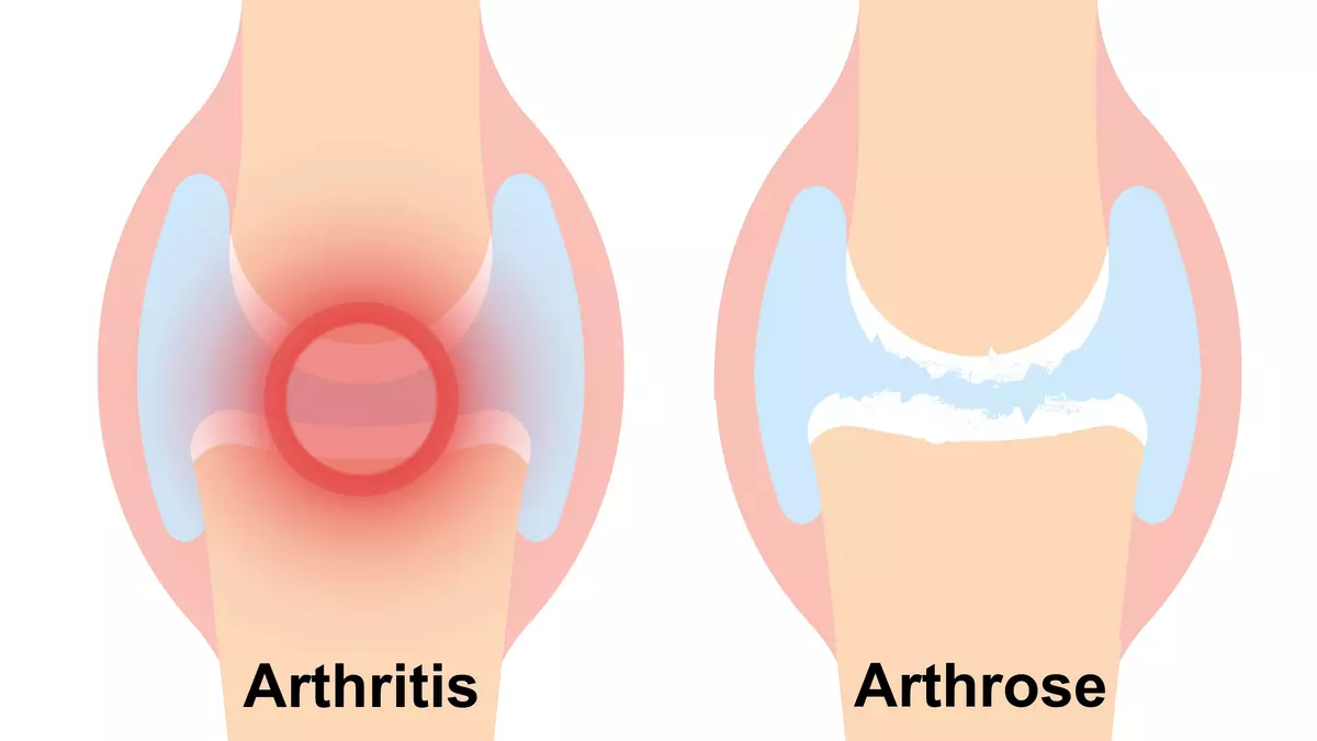 Arthrose von Arthritis unterscheiden | Schwabe Austria